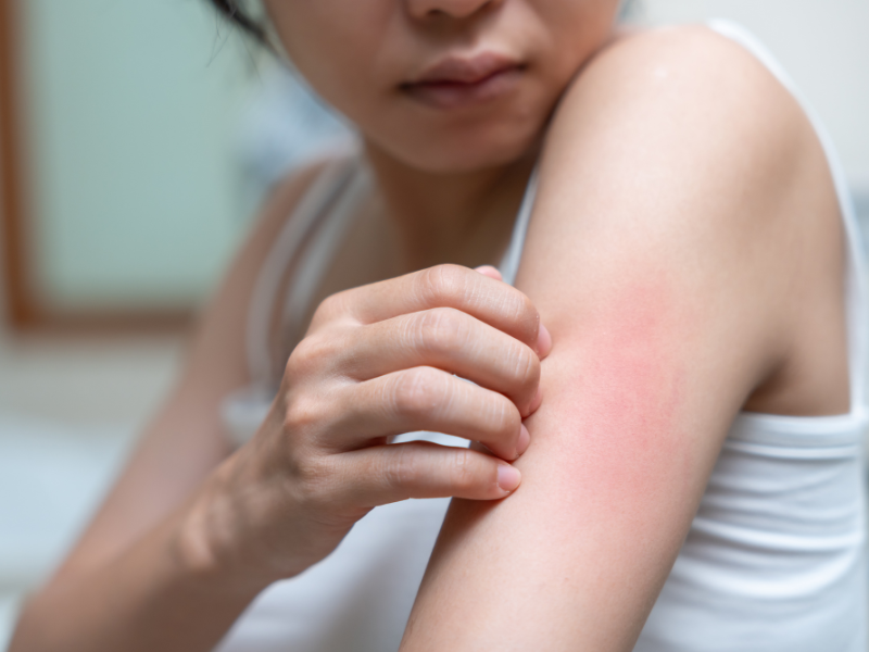 Luonnonmukainen apu syyhyn hoitoon 🪳